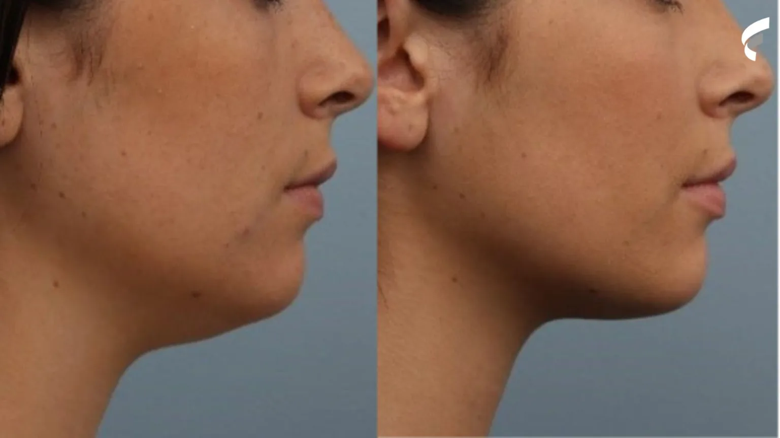 Adeus papada: como funciona o endolaser no rosto e barriga para gordura ...