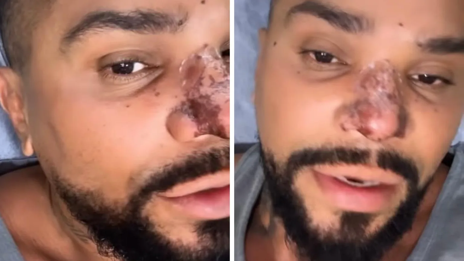 Necrose no nariz após rinomodelação; entenda os riscos - Folha Vitória